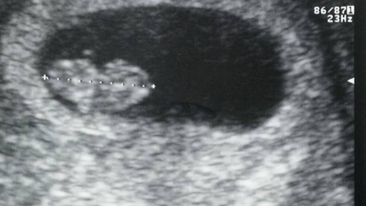 Documentan el primer caso probable de muerte fetal por el virus del ...