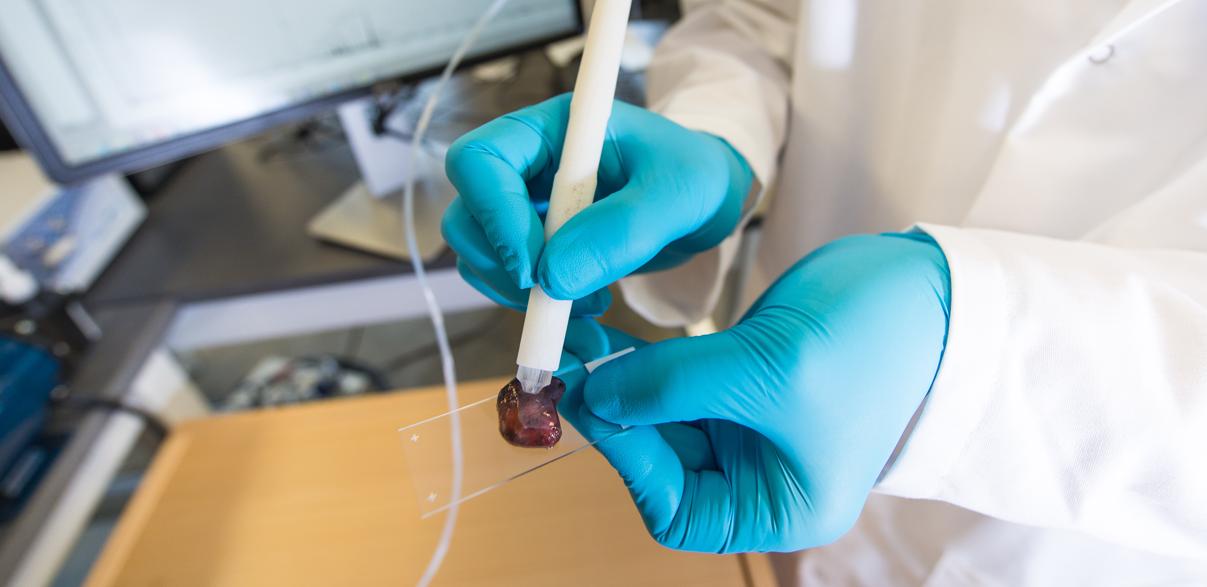 Diseñada una técnica que facilita la extirpación total de un cáncer en ...